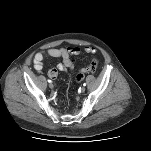 Complex Pelvic Surgery - Maher A. Abbas, MD