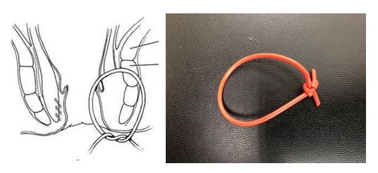 Vaginal Fistula - Maher A. Abbas, MD, proctologist, colorectal surgeon